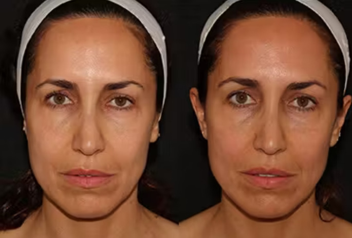 EMRF FACE face muscle training - breezestudio.lv