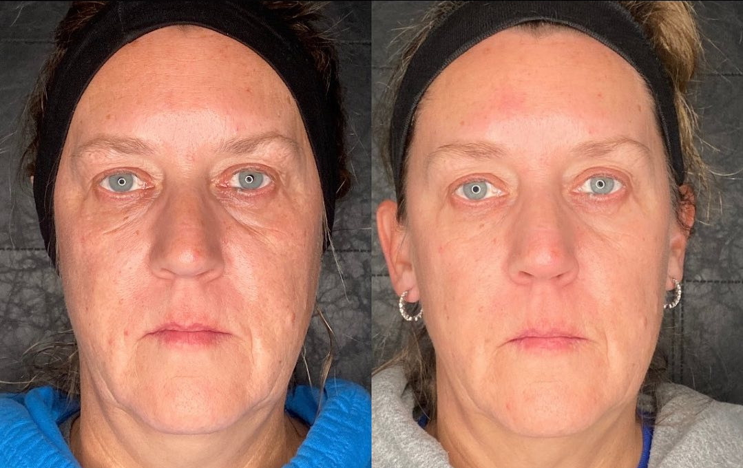 EMRF FACE face muscle training - breezestudio.lv