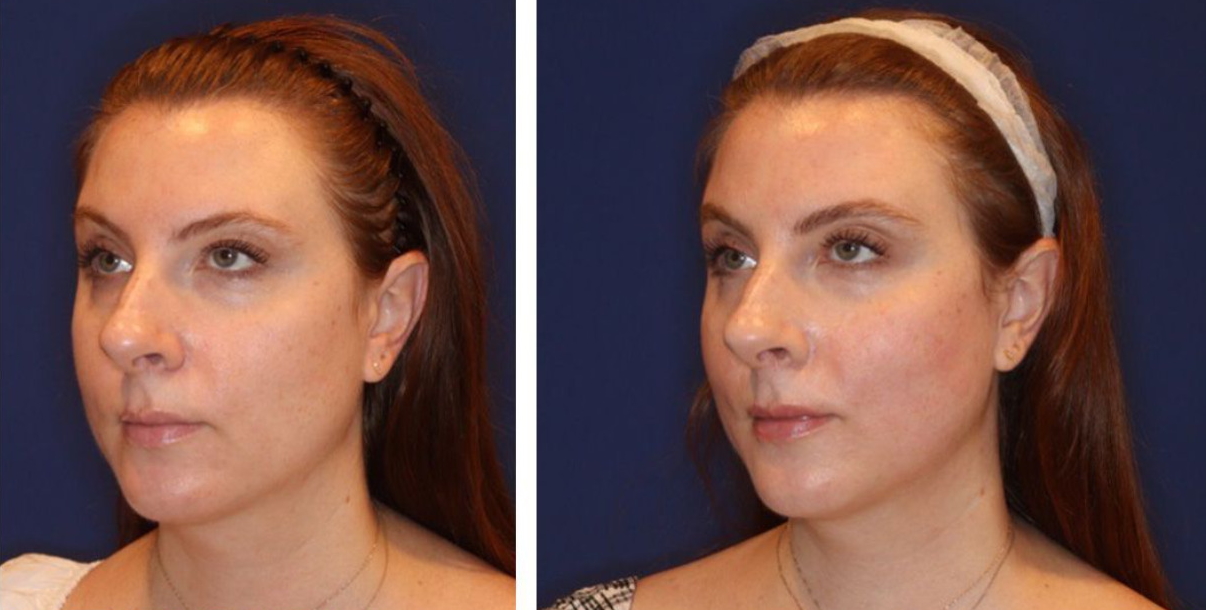 EMRF FACE face muscle training - breezestudio.lv